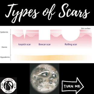 Scar Tissue Vs Normal Skin - My Acne Scars