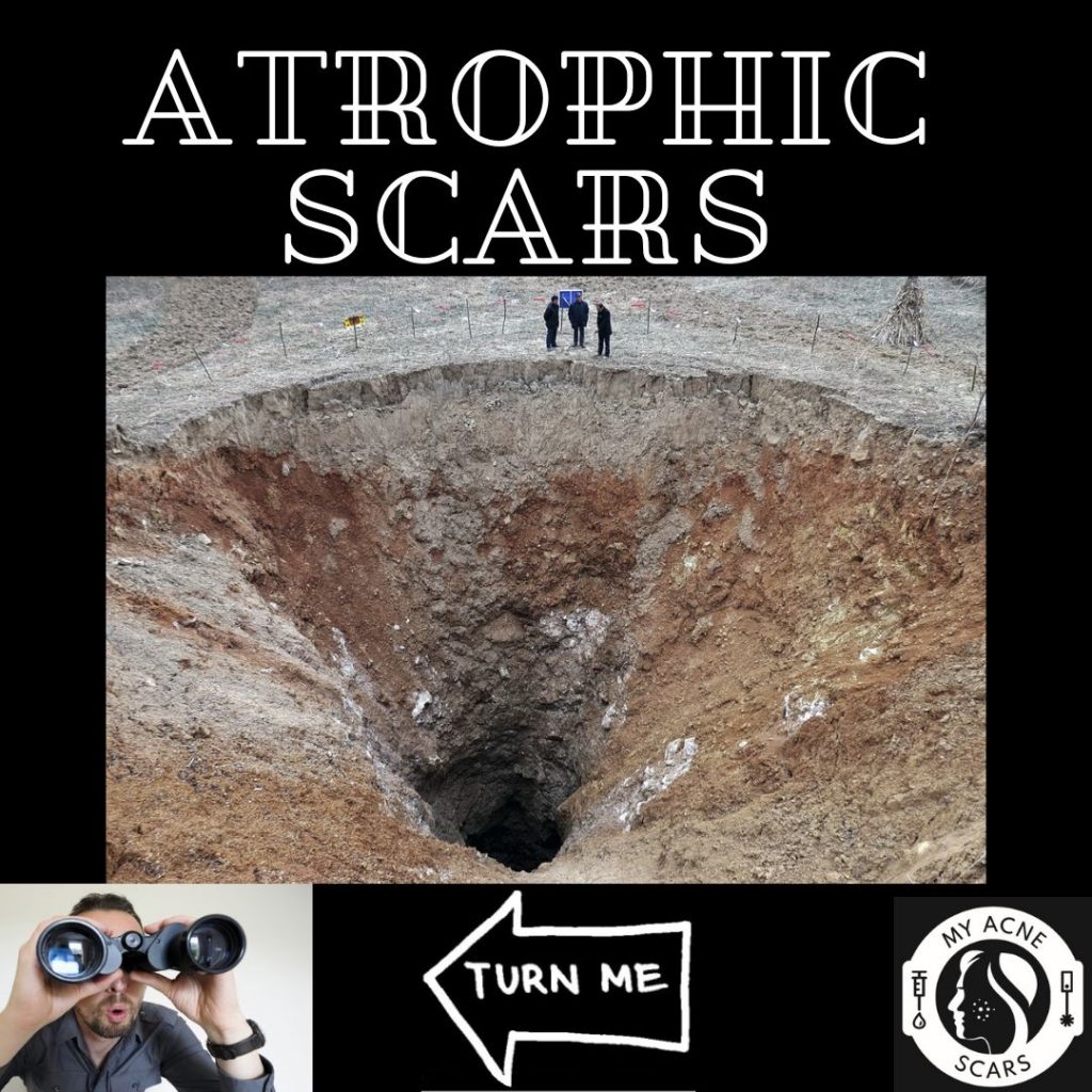 Atrophic Scar: Overview - My Acne Scars