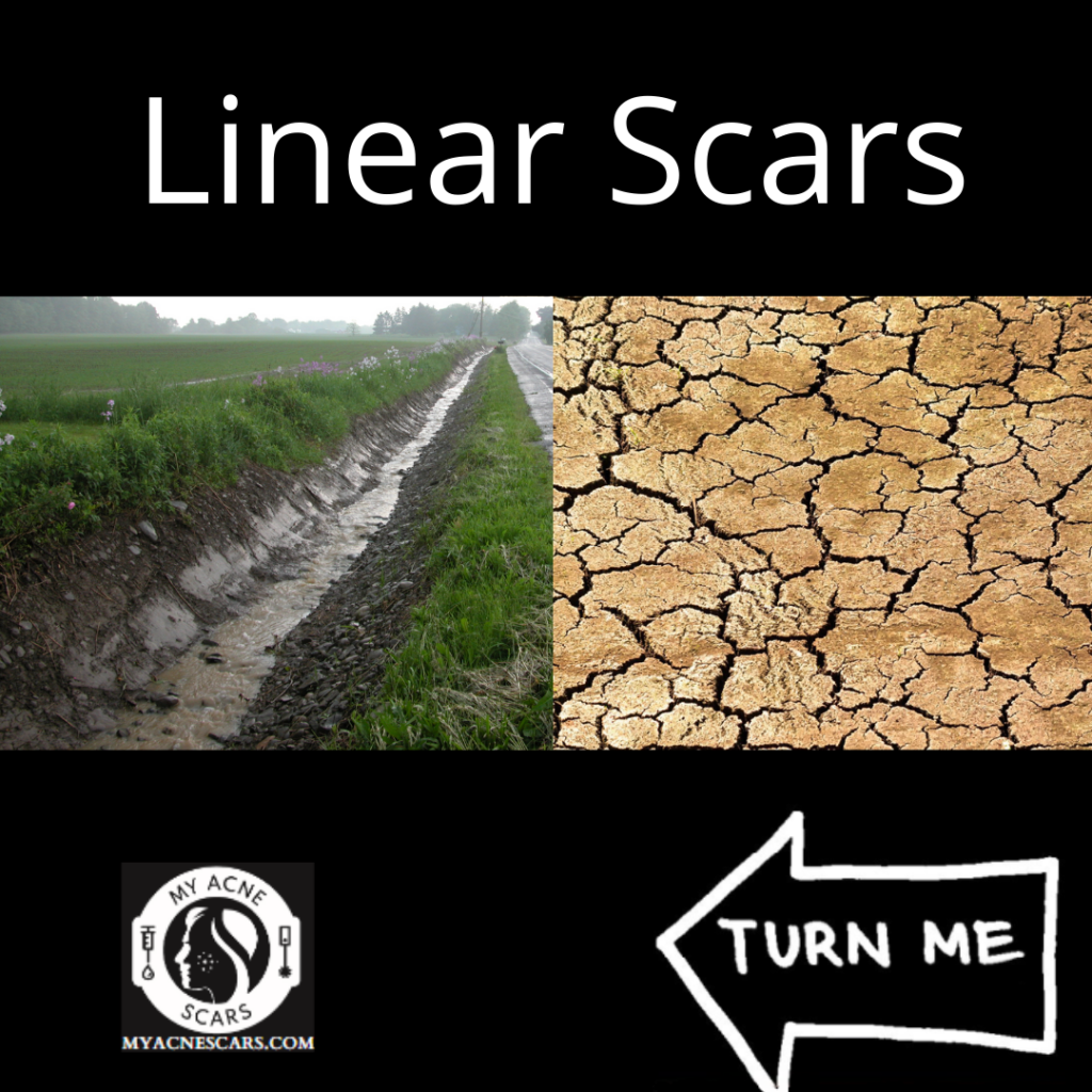 Linear Acne Scars: A Overview - My Acne Scars