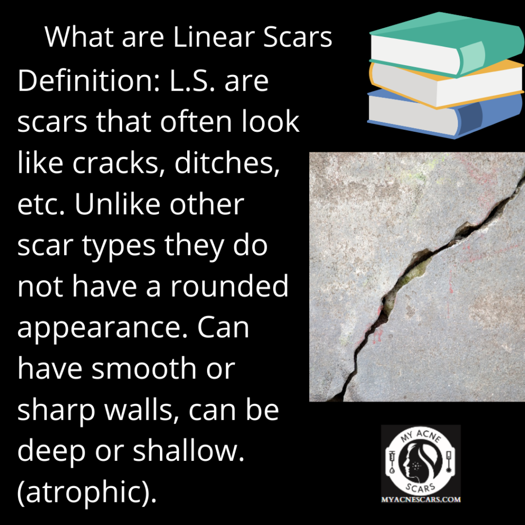 Linear Acne Scars: A Overview - My Acne Scars