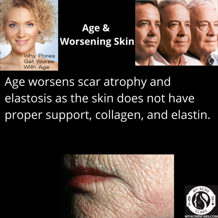 Linear Acne Scars: A Overview - My Acne Scars