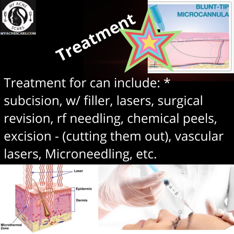 Linear Acne Scars: A Overview - My Acne Scars