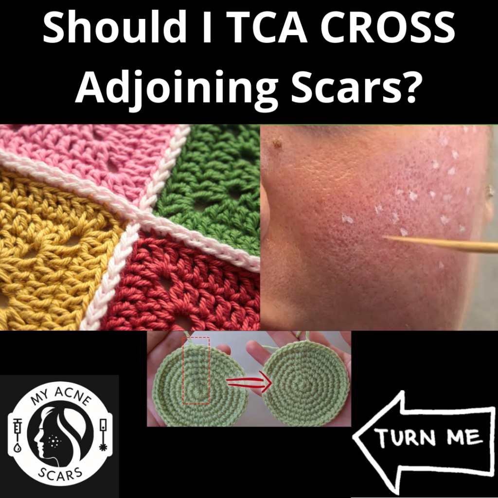 TCA CROSS Used On Adjoining Acne Scars or Pores? - My Acne Scars