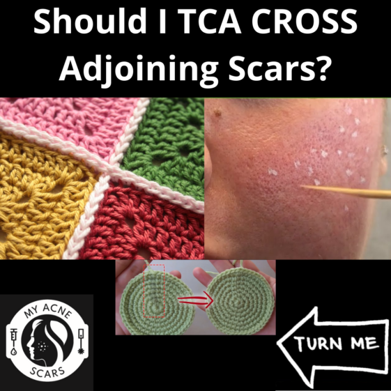 TCA CROSS Used On Adjoining Acne Scars or Pores? - My Acne Scars