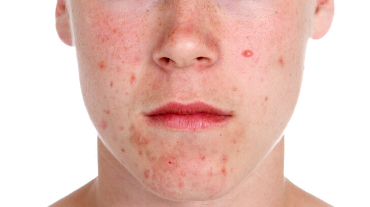 The Side Effects Of TCA CROSS for Acne Scars. - My Acne Scars