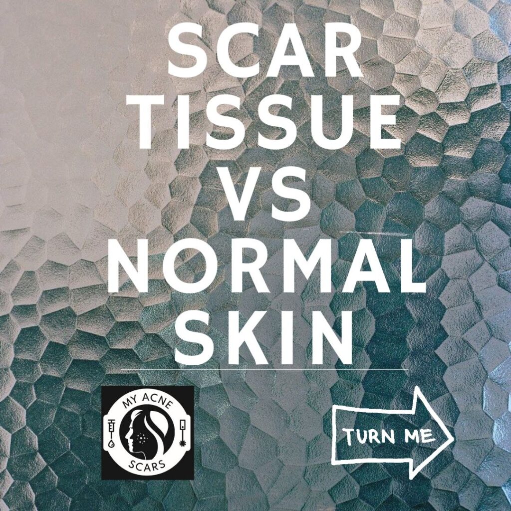 Scar Tissue Vs Normal Skin - My Acne Scars