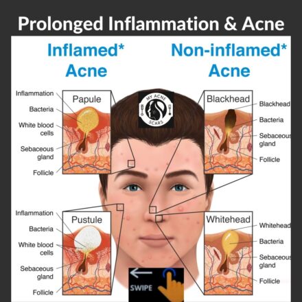 Scar Tissue Vs Normal Skin - My Acne Scars