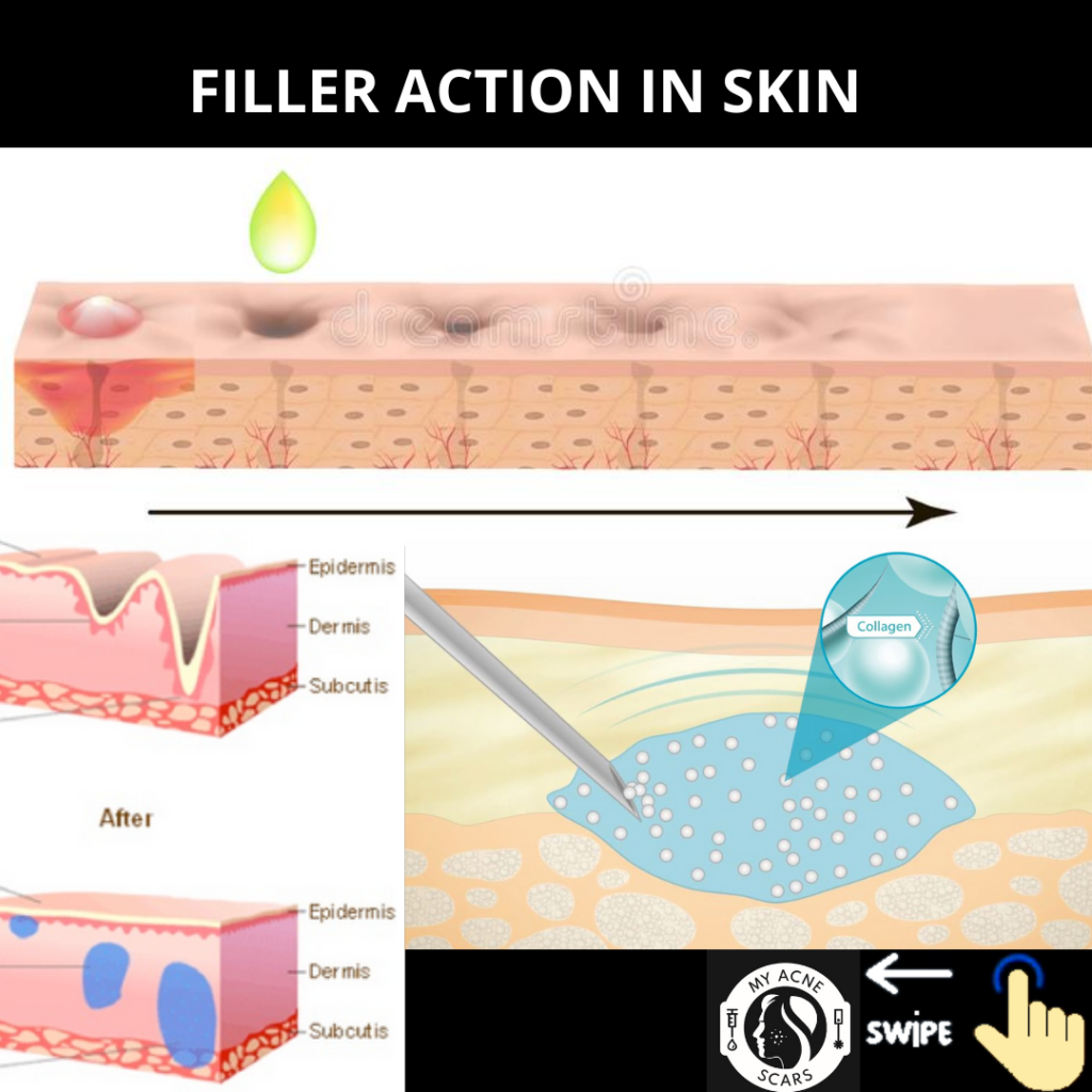 Filler For Acne Scars: Overview - My Acne Scars