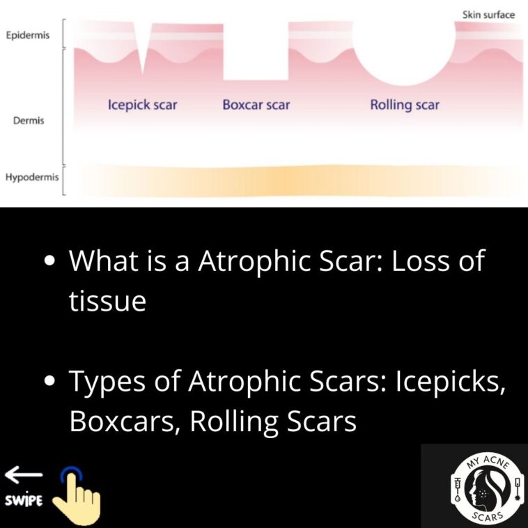 Atrophic Scar: Overview - My Acne Scars