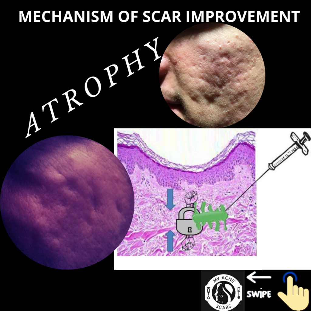 Filler For Acne Scars: Overview - My Acne Scars