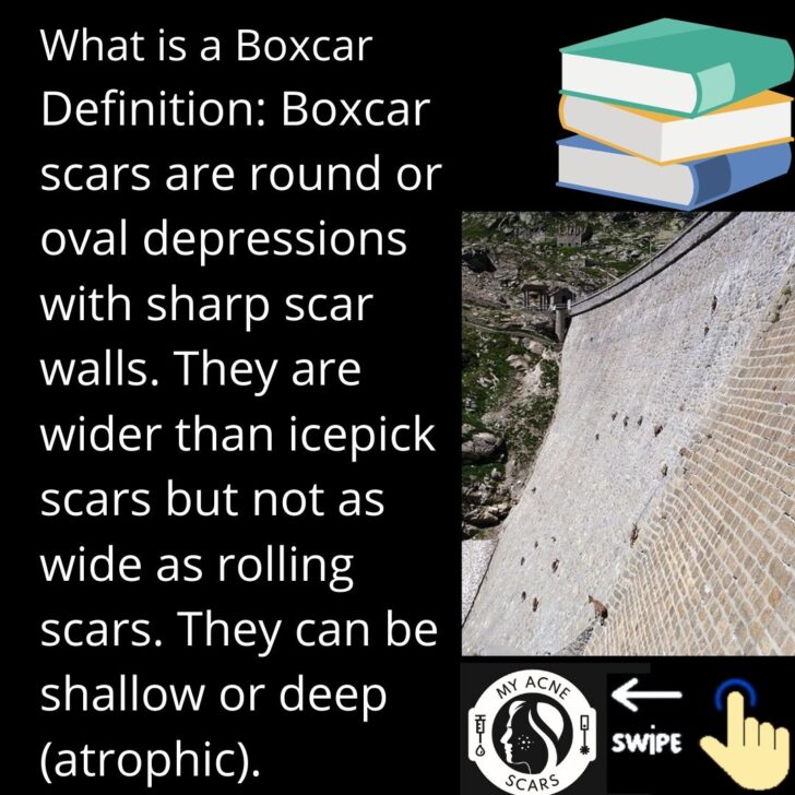 Boxcar Acne Scars - A Overview - My Acne Scars