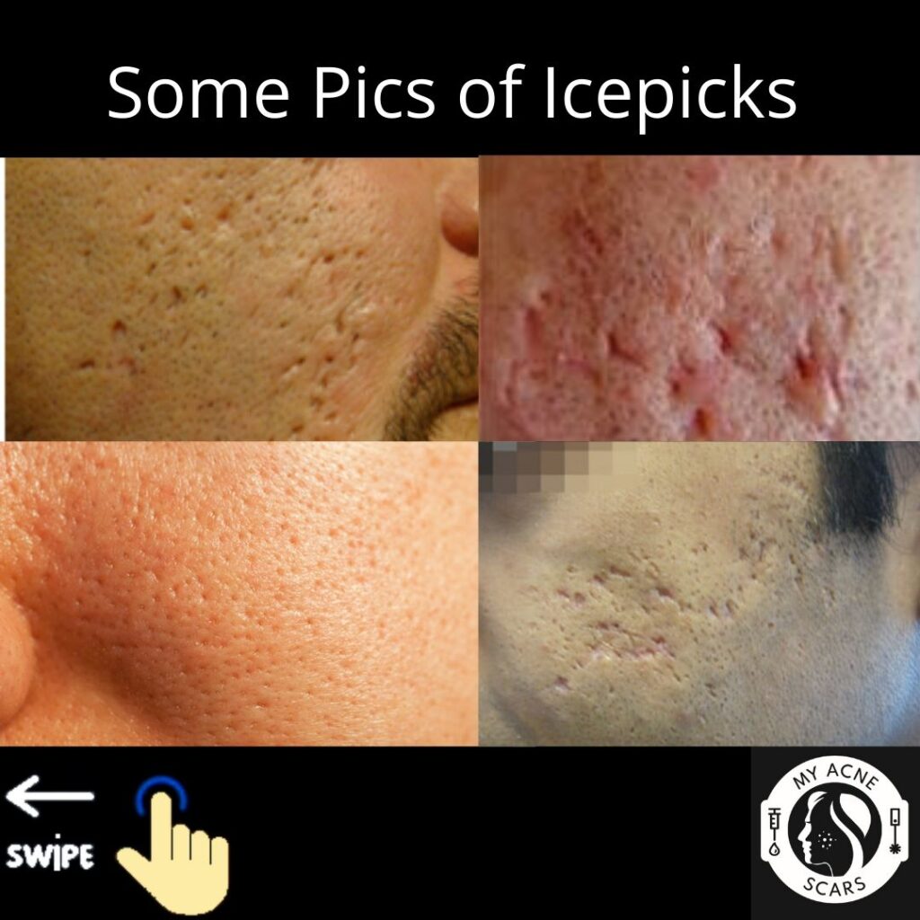 Icepick Acne Scars - A Overview - My Acne Scars