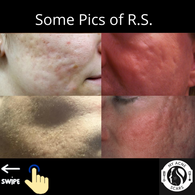 Rolling Acne Scars: Overview - My Acne Scars