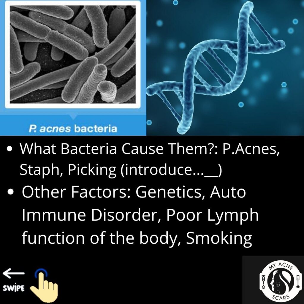 Atrophic Scar: Overview - My Acne Scars