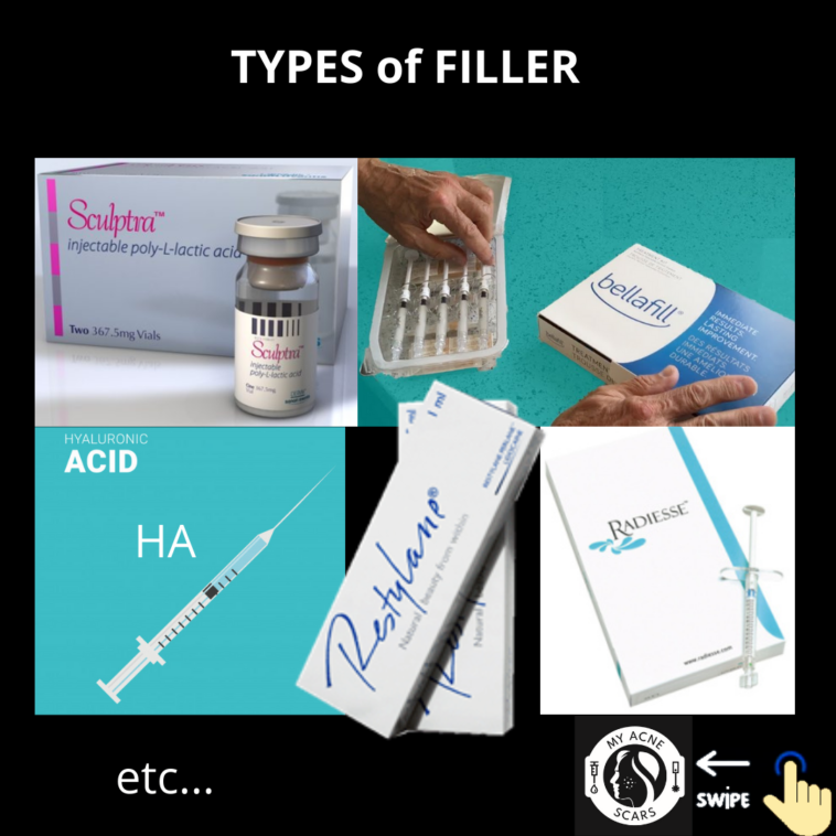 Filler For Acne Scars: Overview - My Acne Scars