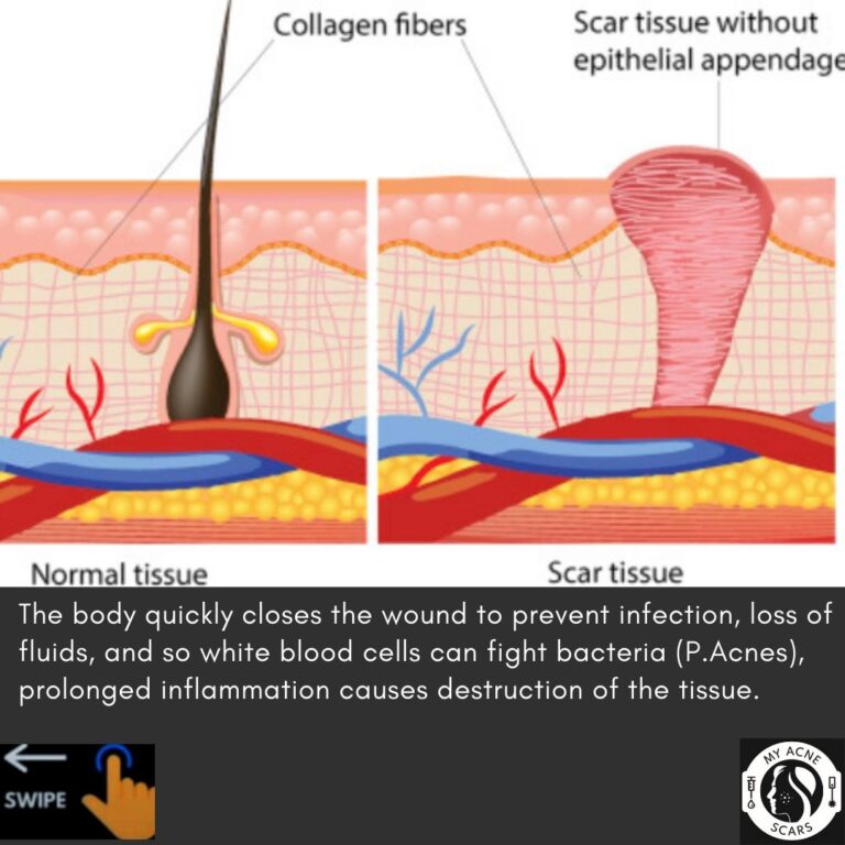 Scar Tissue Vs Normal Skin - My Acne Scars