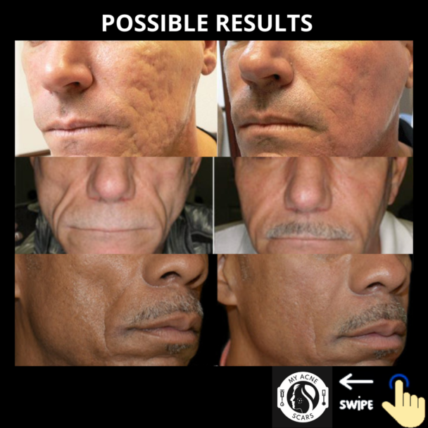 Filler For Acne Scars: Overview - My Acne Scars