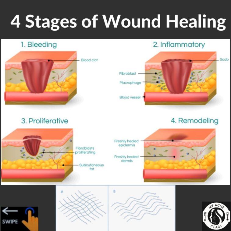 Scar Tissue Vs Normal Skin - My Acne Scars