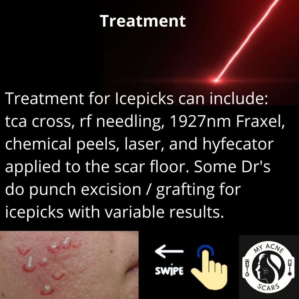 Icepick Acne Scars - A Overview - My Acne Scars
