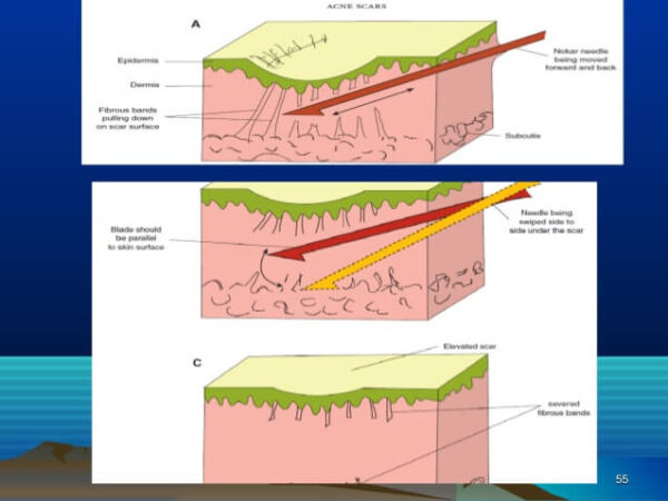 The Side Effects Of Subcision for Acne Scars. - My Acne Scars